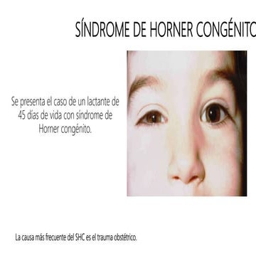 Sindrome de horner congenito | PPTX