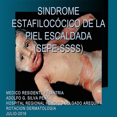 Sindrome estafilocócico de la piel escaldada | PPT