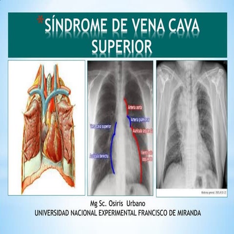 Sindrome vena cava superior | PDF