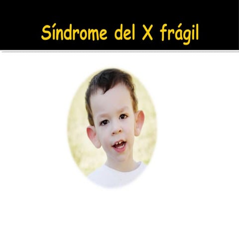 Sindrome del X Fragil | PPT