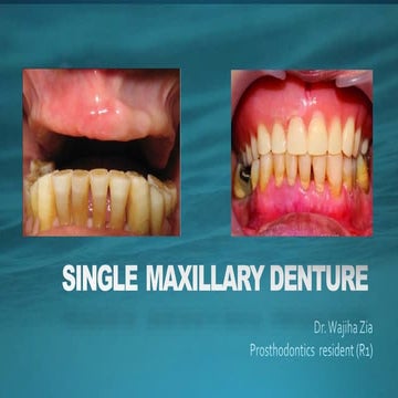 SINGLE MAXILLARY DENTURE AND ITS MANAGEMENT | PPTX