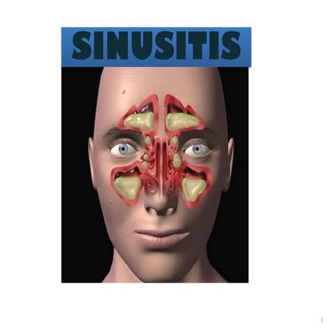sinusitis advanced.powerpoint presentations | PPTX