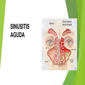 Sinusitis Aguda.pptx