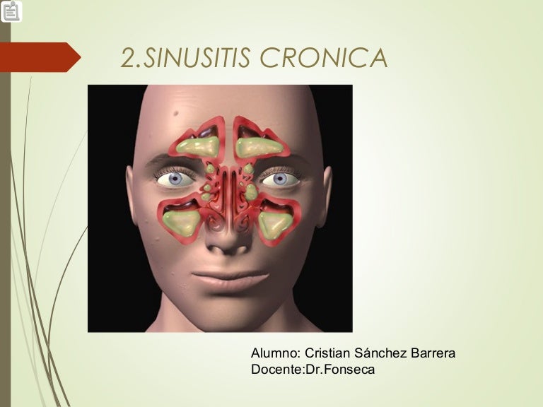 Sinusitis cronica Cristian Sanchez barrera Dr.fonseca