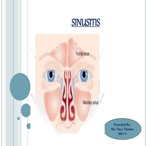 Sinusitis | PPT