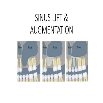 SINUS LIFT AUGMENTATION presentation.pptx