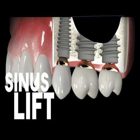 sinus lift | PPTX