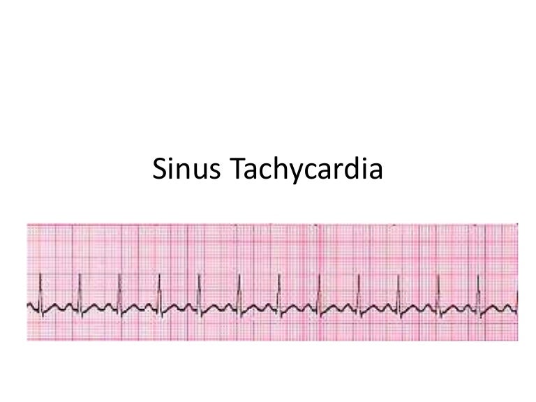 Sinus tachycardia