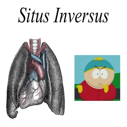 Situs inversus | PPTX
