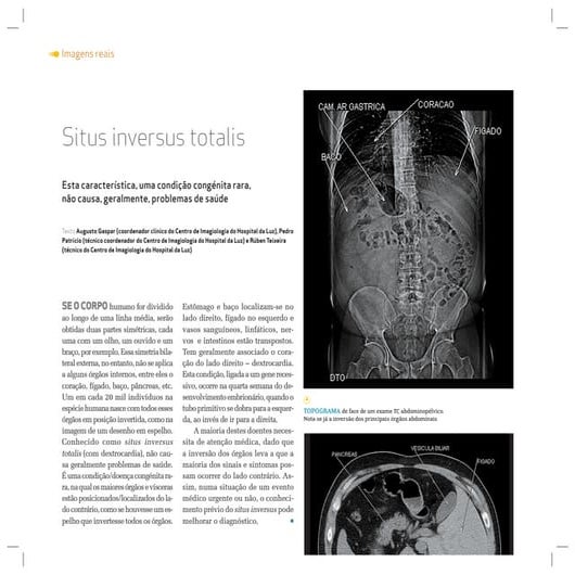 Situs inversus totalis | PDF