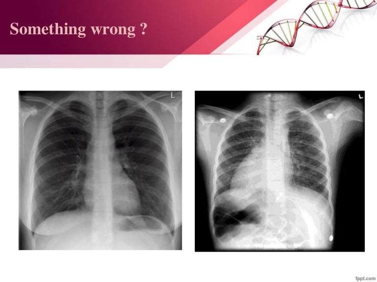 Situs inversus totalis
