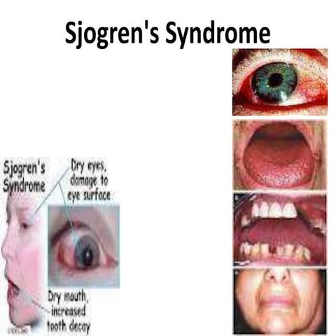 Sjogren's syndrome | PPTX