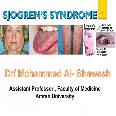 lecture 2026 of Sjogren's syndrome l .pdf
