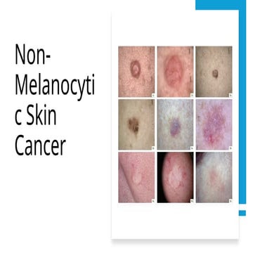 skin cancer non melanocytic dermatoscopy | PPTX