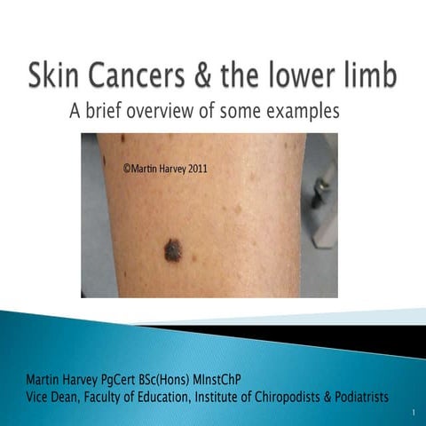 Skin Cancer And The Lower Limb | PPTX