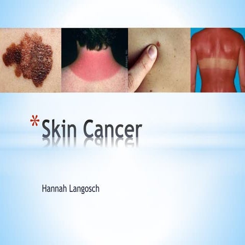 Skin Cancer | PPT
