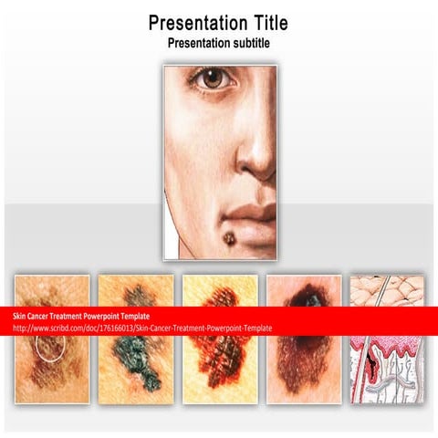 Skin Cancer Treatment Powerpoint Template | PPT