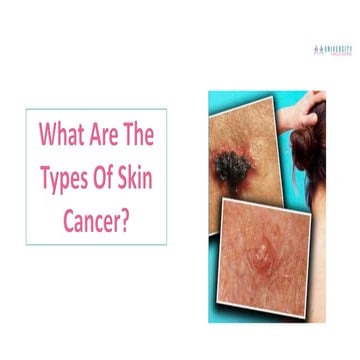 Skin Cancer Types | PPTX