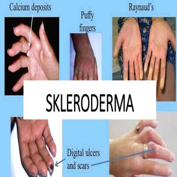 Skleroderma | PPTX