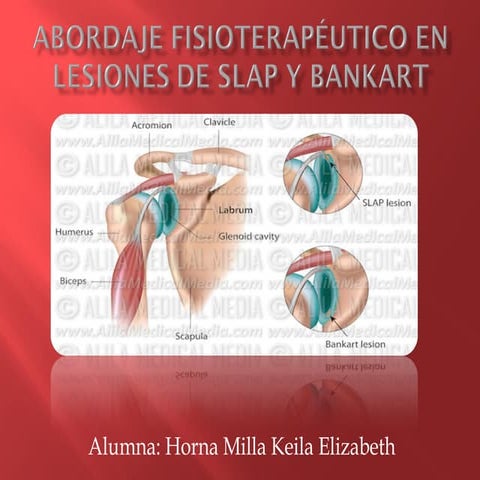 Slap y bankart | PPT
