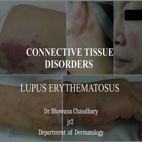 SYSTEMIC LUPUS ERYTHEMATOSUS .pptx dermatology | PPTX