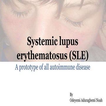 Systemic lupus erythematosus (SLE) disease | PPTX