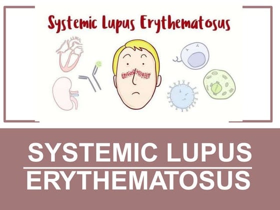 Systemic lupus erythematosus (SLE) | PPTX