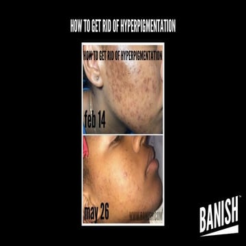 HOW TO GET RID OF HYPERPIGMENTATION | PDF