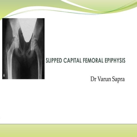 Slipped capital femoral epiphysis | PPTX
