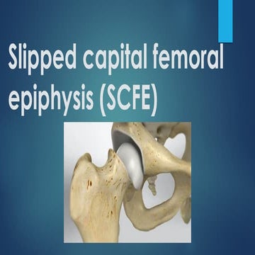 Slipped capital femoral epiphysis (SCFE).pptx