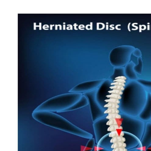 Slipped disc causes, symptoms and treatment. | PDF
