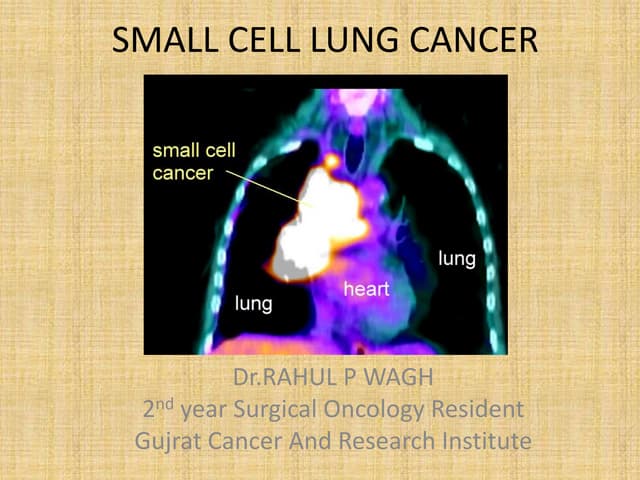Treatment options for lung cancer | PPTX