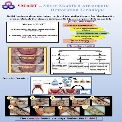 SMART – Silver Modified Atraumatic Restoration (1) (1).pptx