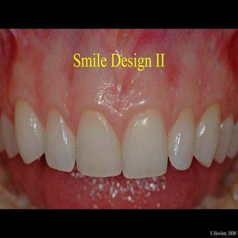 Smile Designs II, things to consider .pdf