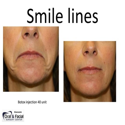 Smile line using botox | PDF | Cosmetic Medical Services | Medical Health