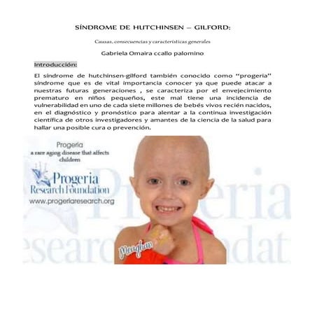 Síndrome de Hutchinsen-Gilford | DOCX