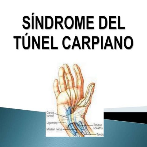 Síndrome del túnel carpiano | PPTX