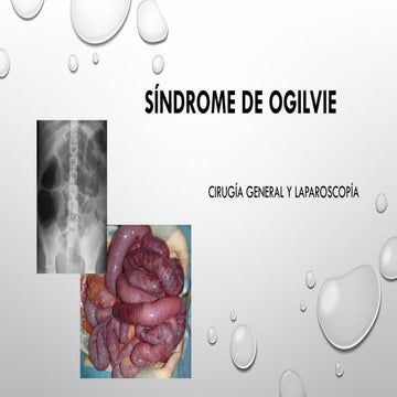 SÍNDROME DE OGILVIE - PESUDO-OBTSRUCCION | PPTX
