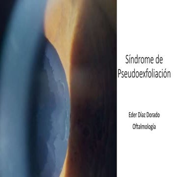 Síndrome de pseudoexfoliación | PPTX