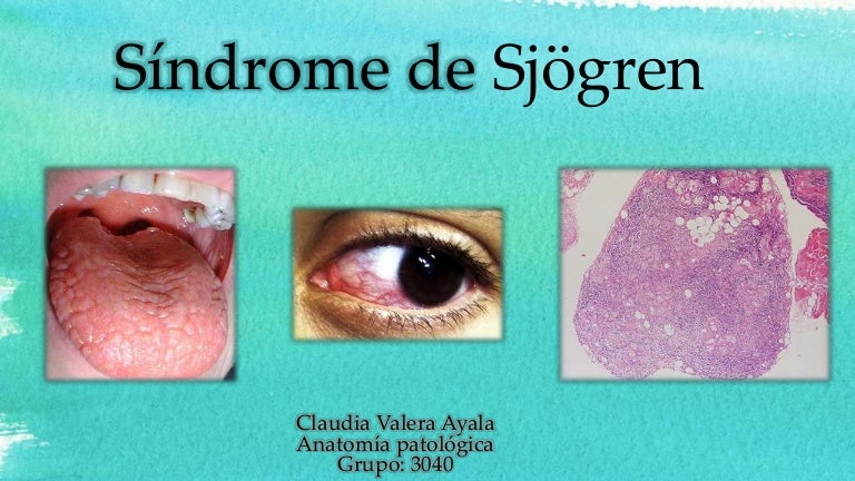 Síndrome de Sjogren