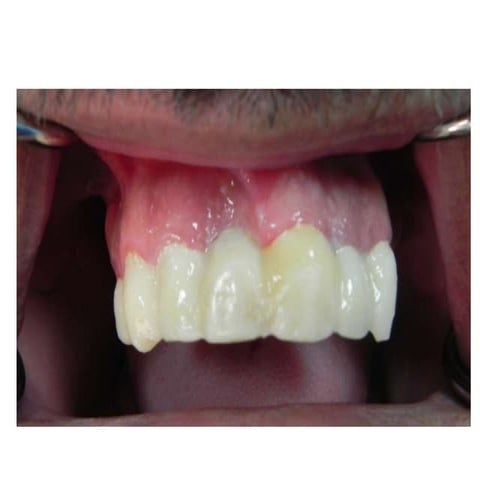 Soft tissue augmentation | PPT