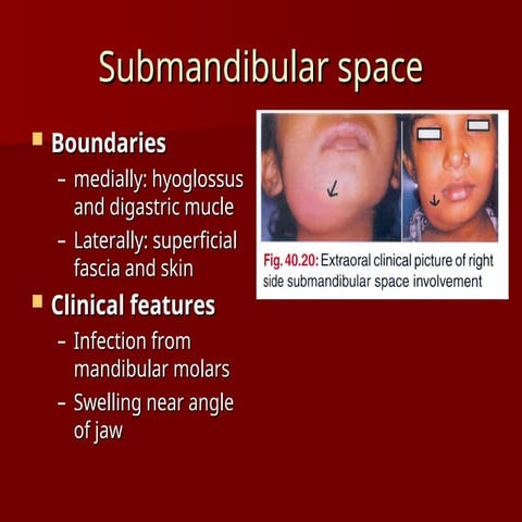 Space infection of SUB mand,mental & lingual.ppt
