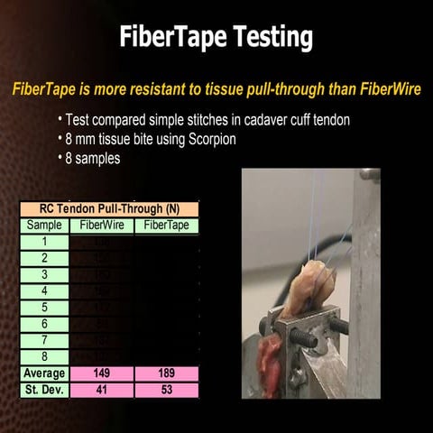 Speed bridge kit | PPT | Surgery | Medical Health