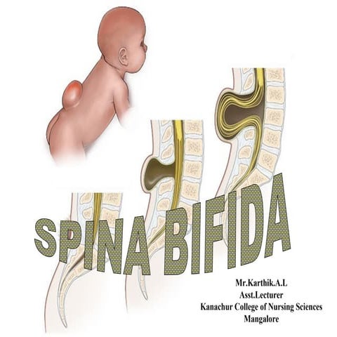 Spina bifida