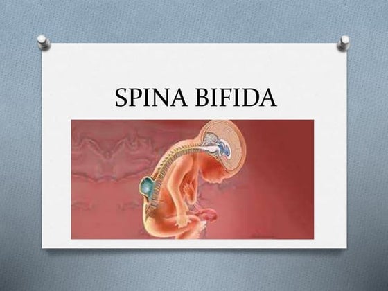 Spina bifida Neurological disorder | PPTX
