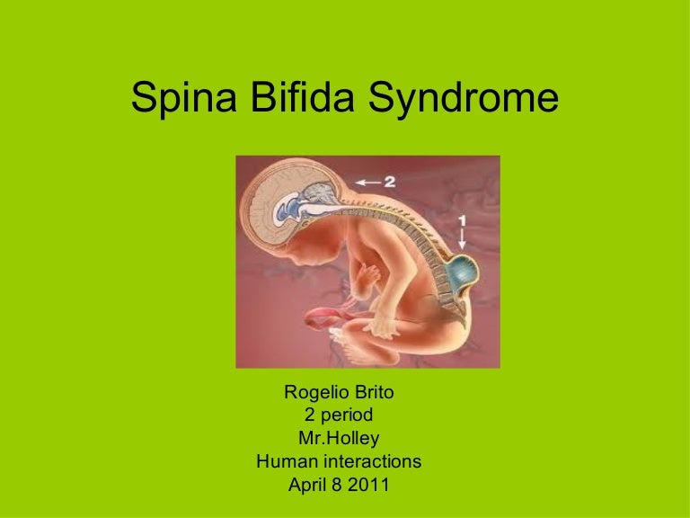 Spina bifida syndrome p3
