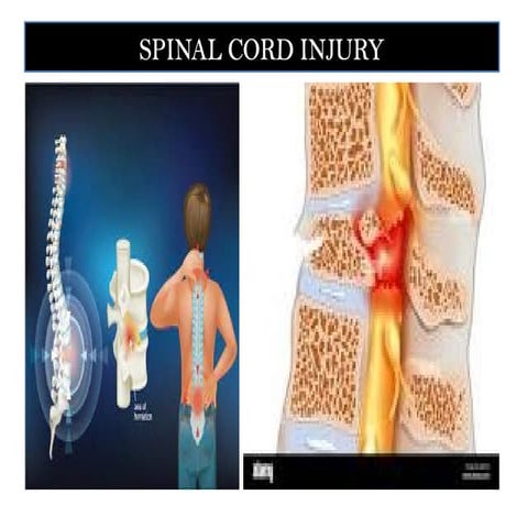 Spinal cord injury nursing care 3rd yr.pptx