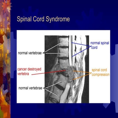 Spinal Cord Syndrome | PPT