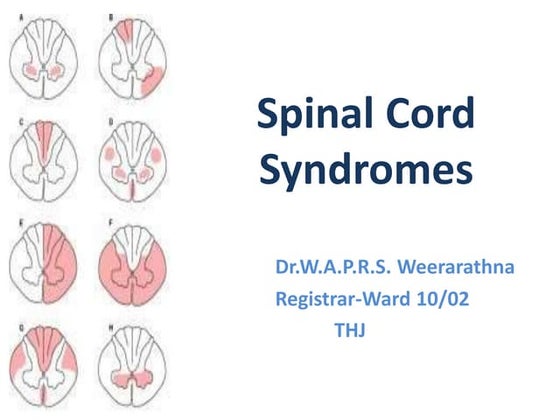Intramedullary vs extramedullary spinal cord lesions | PPTX