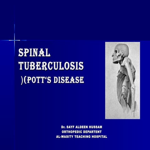 Pott's disease ppt | PPTX